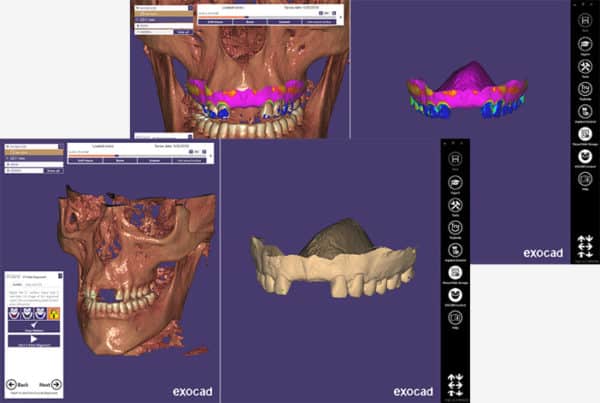 Exocad Dental Cad: Software Digital | Odontología Digital | Techdent